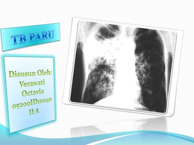 POWERPOINT TB PARU | PPTX