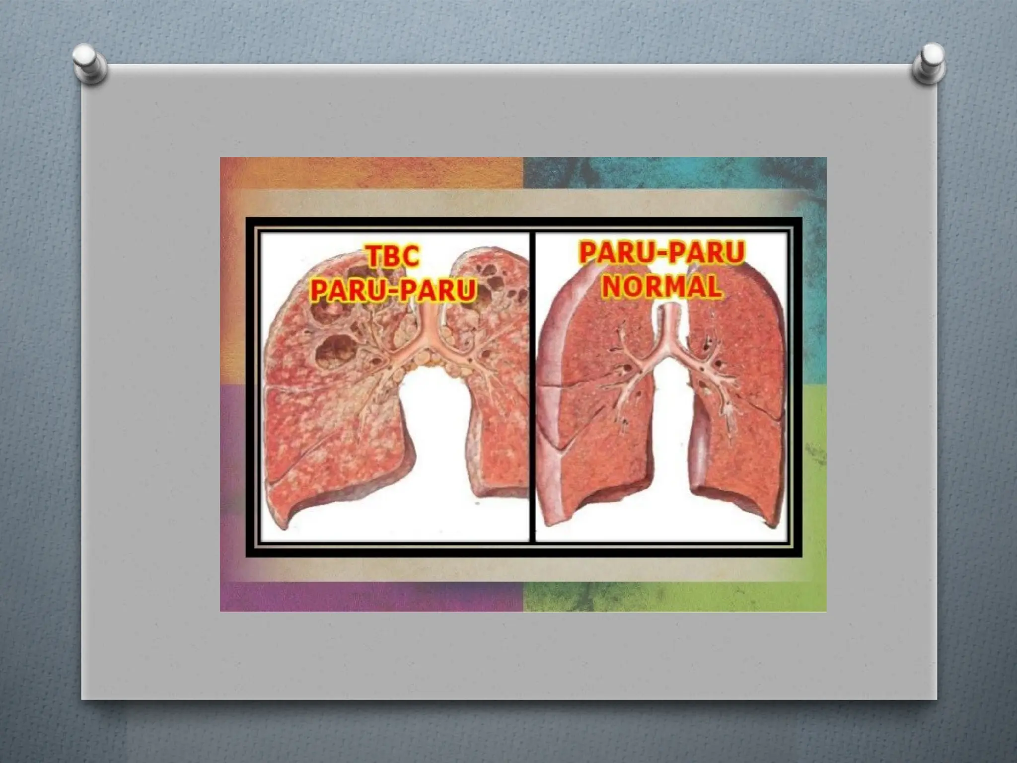 POWERPOINT KEPERAWATAN TUBERCULOSIS PARU.pptx