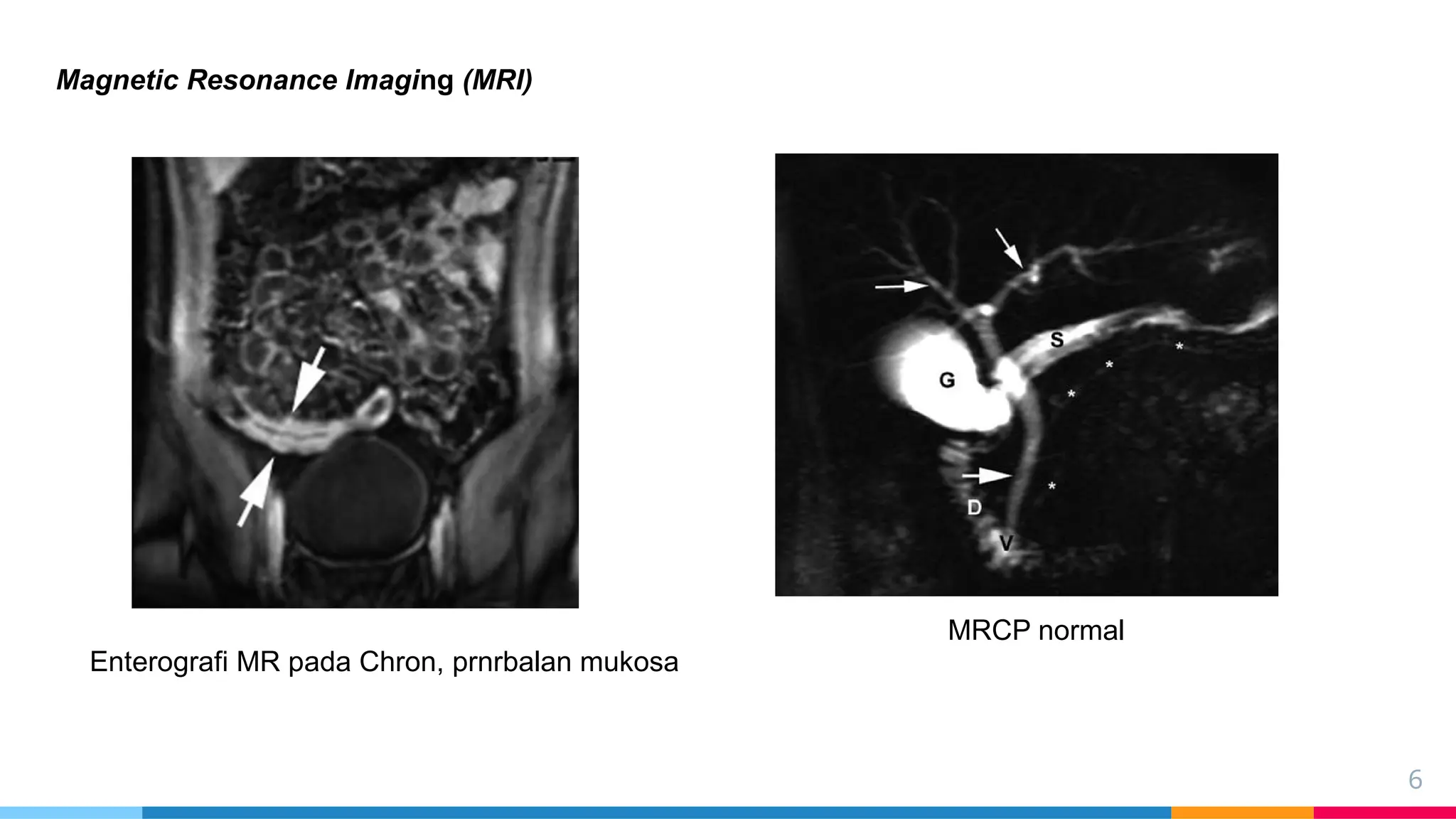 Ppt TBR radiologi gastrointestinal imaging. pptx | PPTX