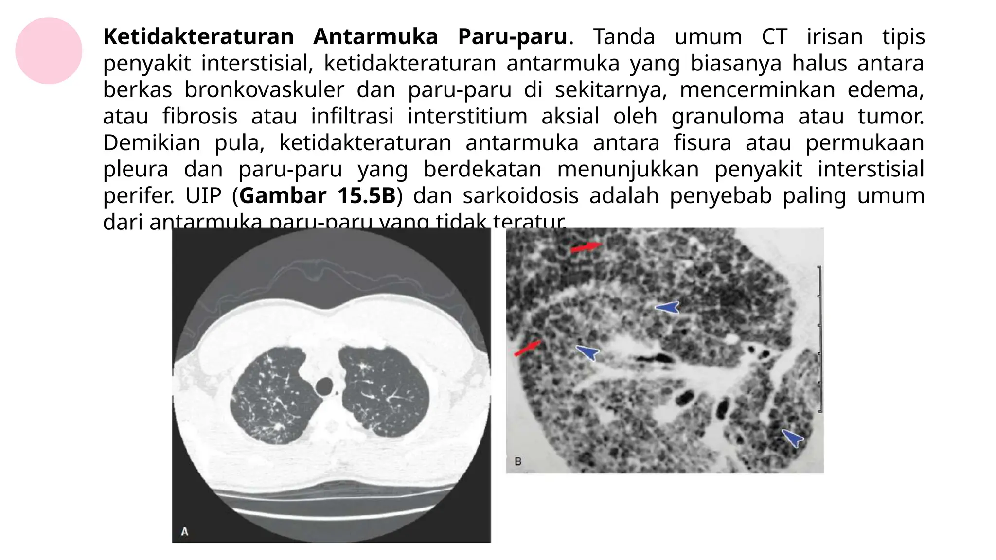 Text Book Reading "Penyakit Paru Difus (Tanda-tanda Penyakit pada CT ...