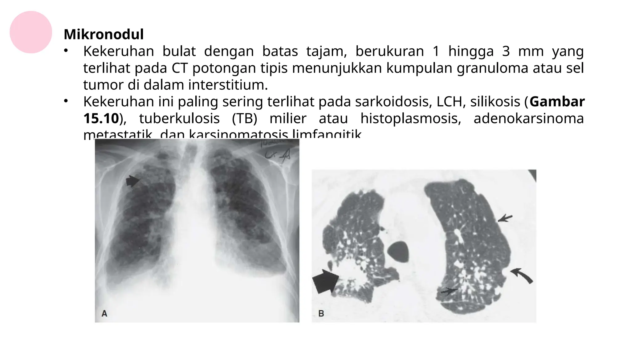 Text Book Reading "Penyakit Paru Difus (Tanda-tanda Penyakit pada CT ...