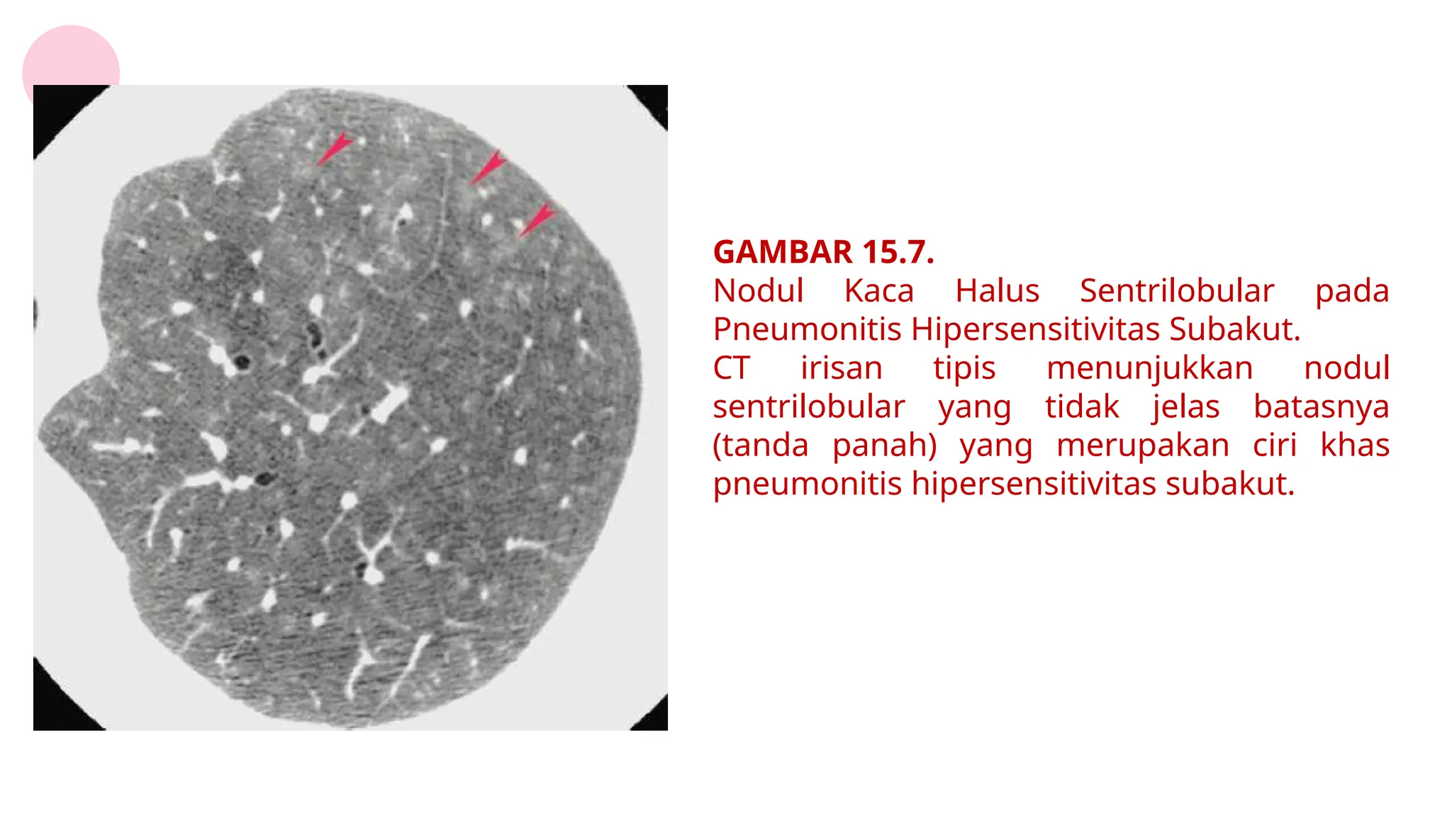 Text Book Reading "Penyakit Paru Difus (Tanda-tanda Penyakit pada CT ...