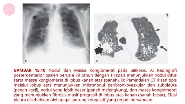 Text Book Reading "Penyakit Paru Difus (Tanda-tanda Penyakit pada CT ...