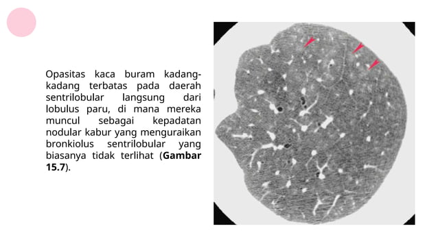 Text Book Reading "Penyakit Paru Difus (Tanda-tanda Penyakit pada CT ...