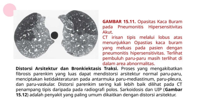 Text Book Reading "Penyakit Paru Difus (Tanda-tanda Penyakit pada CT ...