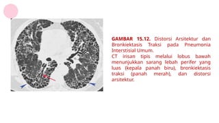 Text Book Reading "Penyakit Paru Difus (Tanda-tanda Penyakit pada CT ...