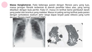Text Book Reading "Penyakit Paru Difus (Tanda-tanda Penyakit pada CT ...