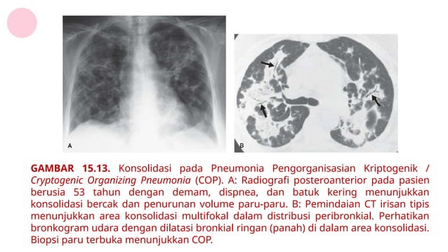 Text Book Reading "Penyakit Paru Difus (Tanda-tanda Penyakit pada CT ...