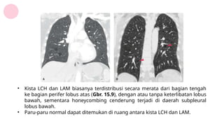 Text Book Reading "Penyakit Paru Difus (Tanda-tanda Penyakit pada CT ...