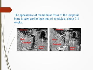 Temporomandibular joint development and applied aspects | PPTX