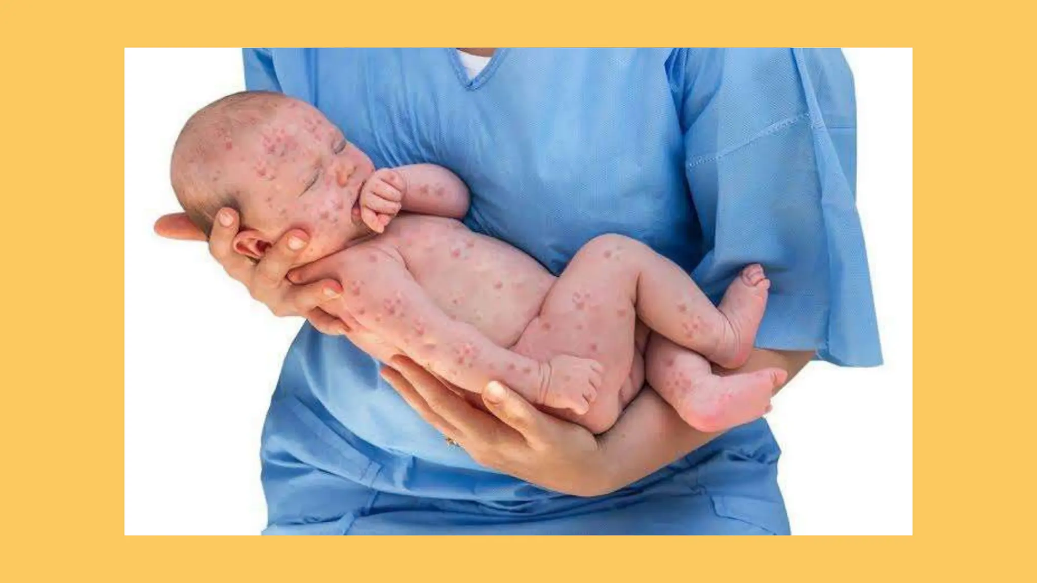 ppt Toxoplasma gondii (Toxo), Rubella, Cyto Megalo Virus (CMV), Herpes ...