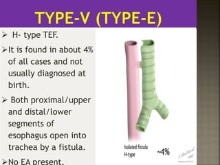 Tracheoesophageal Fistula Classification