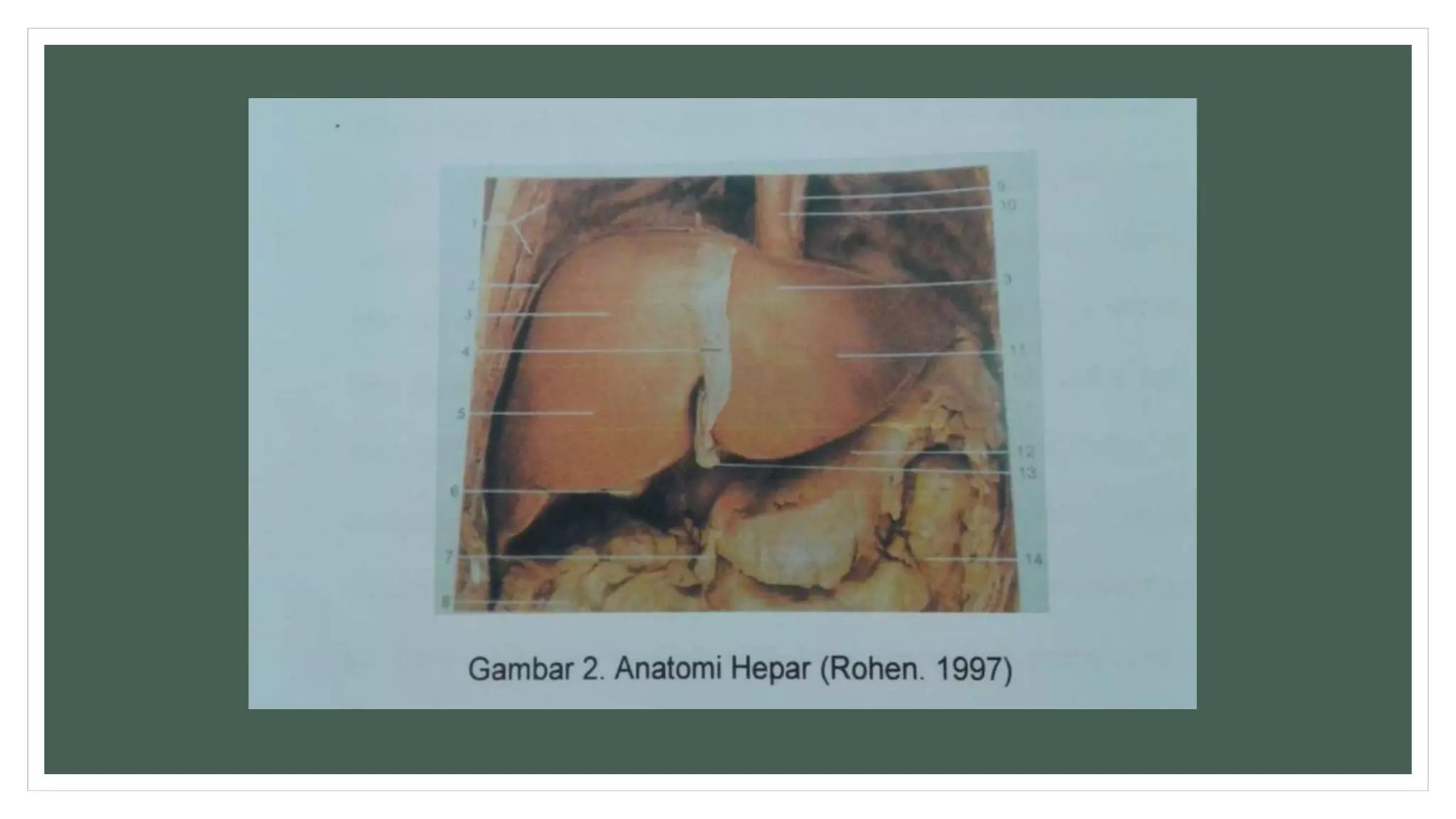 Ppt ct scan abdomen pada kasus tumor hati | PPTX