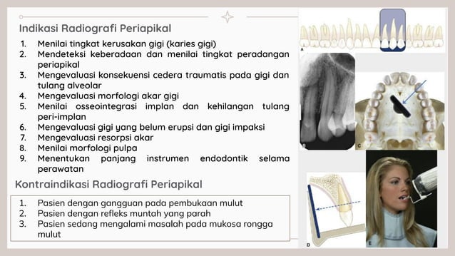 PPT TUTOR KELOMPOK 2 TUTOR PERIODONTITIS.pdf