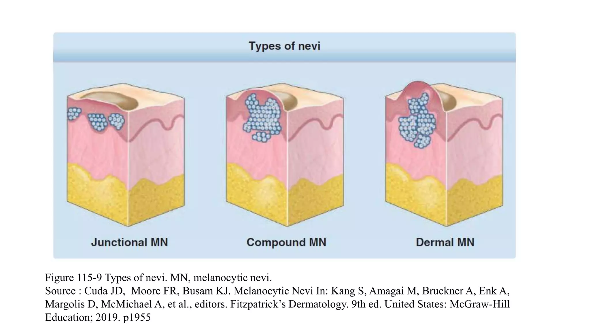 PPT Types of Common Acquired Melanocytic Nevi.pptx