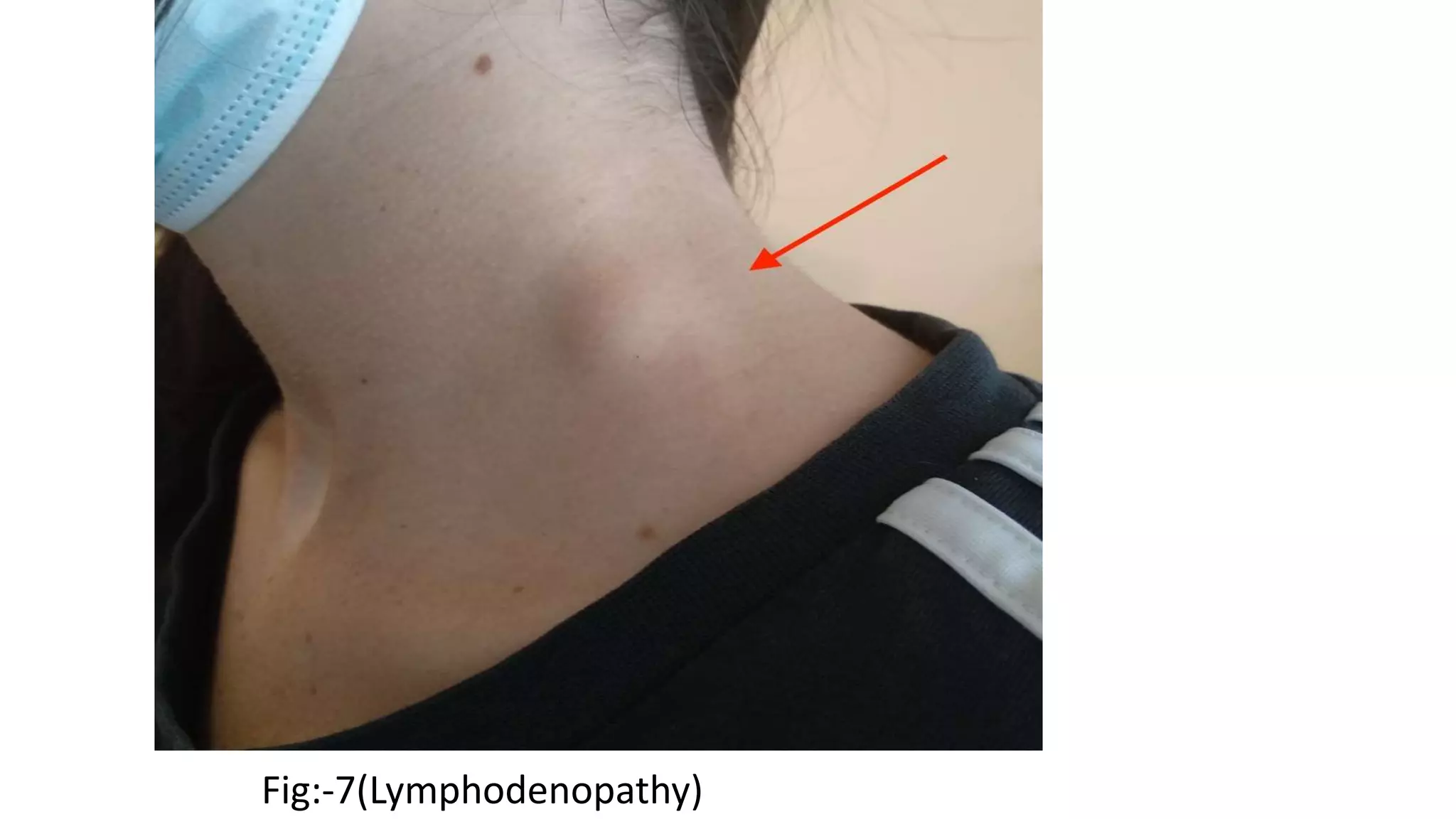 Ppt typhus fever 01.pptx