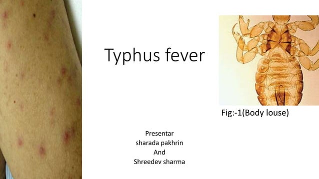 Ppt typhus fever 01.pptx | Infectious Diseases | Diseases and Conditions
