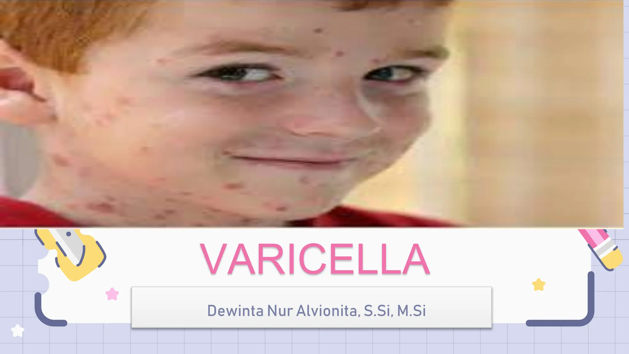 PPT VARICELLA.pptx