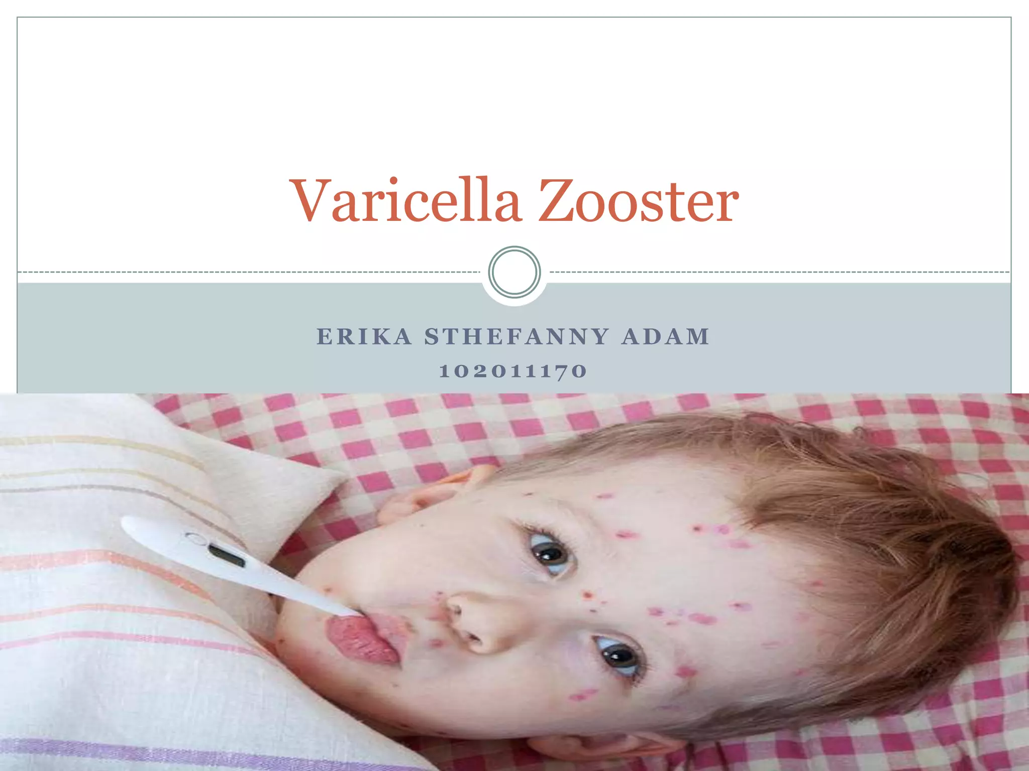 varicella zooster | PPTX