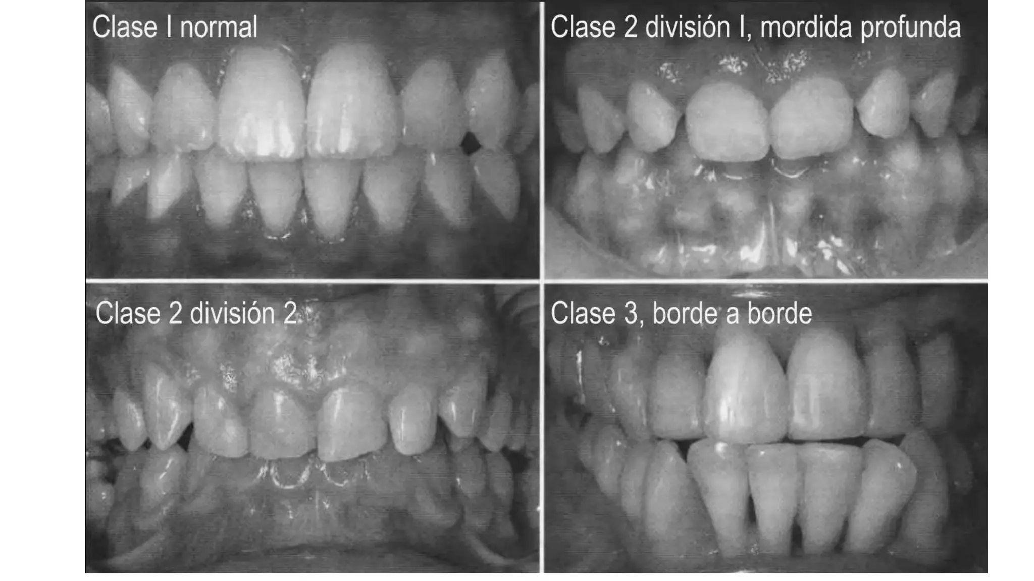 Morfología oclusal, materia de oclusión 1 | PPTX