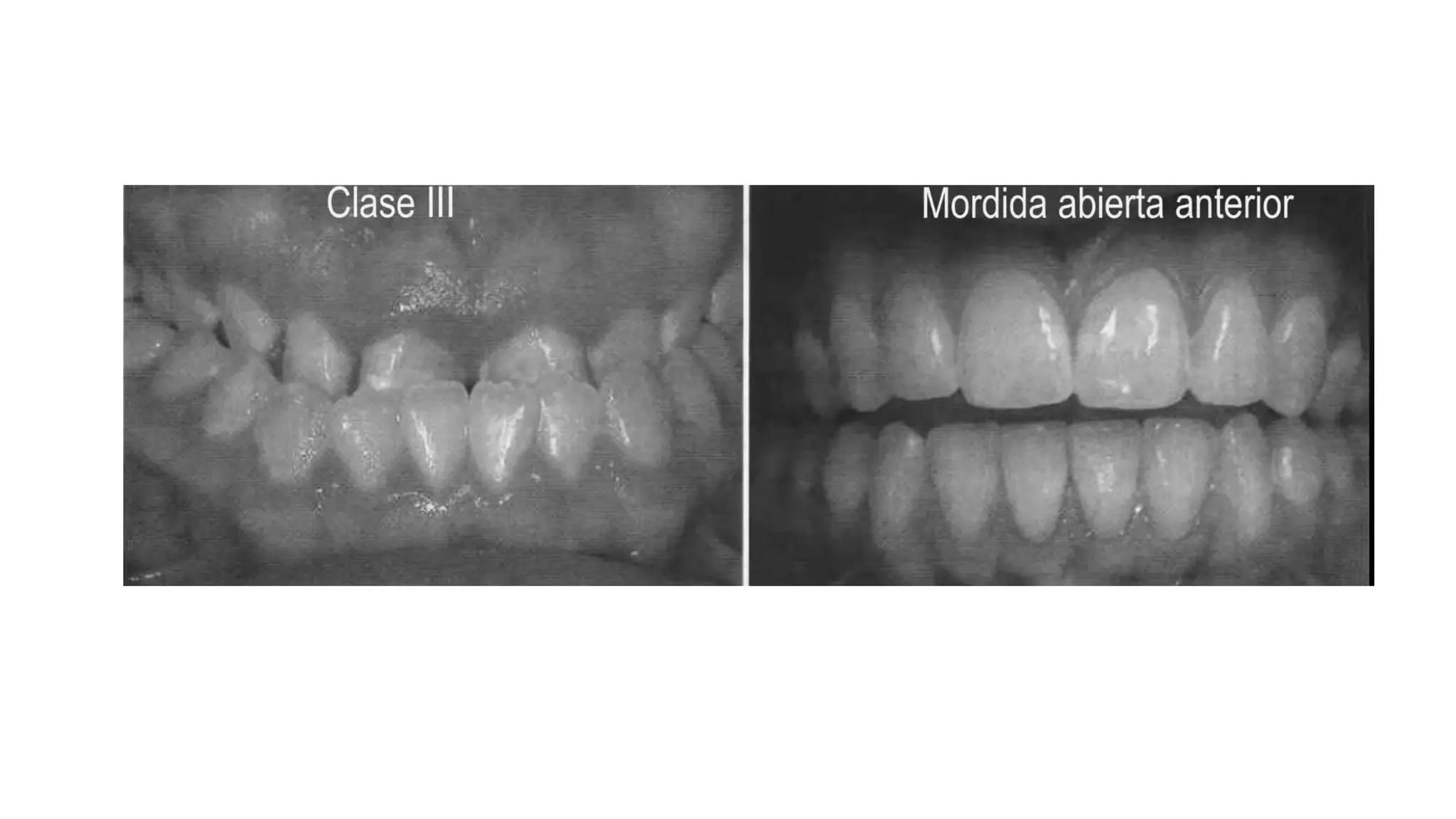 Morfología oclusal, materia de oclusión 1 | PPTX