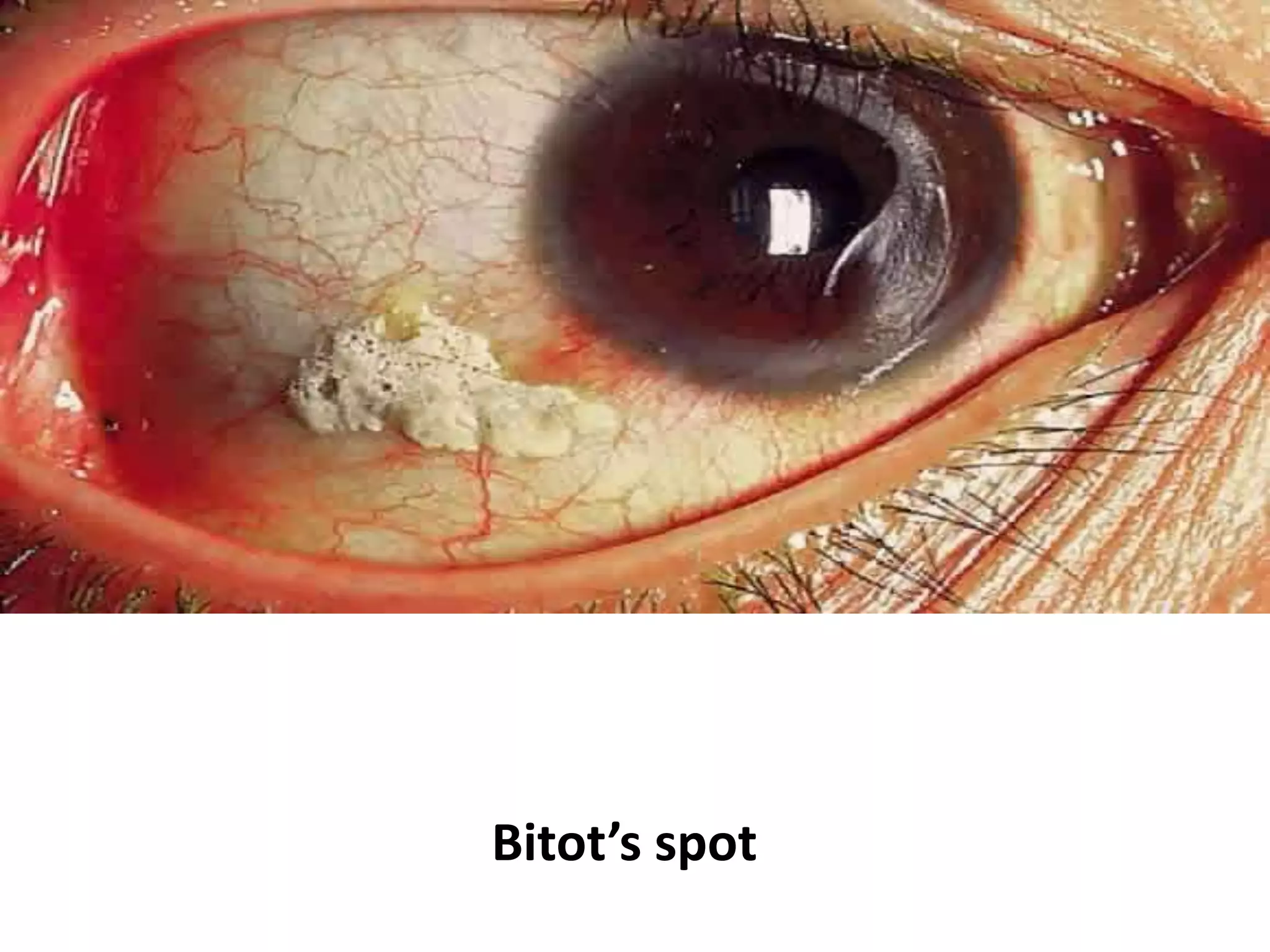 ppt xeropthalmia.pptx