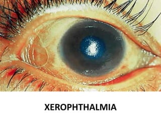 Xerophthalmia