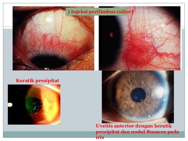 ASUHAN KEPERAWATAN PENYAKIT UVEITIS MATA