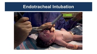 positive pressure ventilation in NRP | PPTX