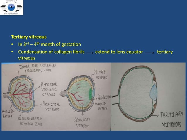 vitreous_anatomy__AND_SUBSTITUTE presentation dhir hospital bhiwani.pptx