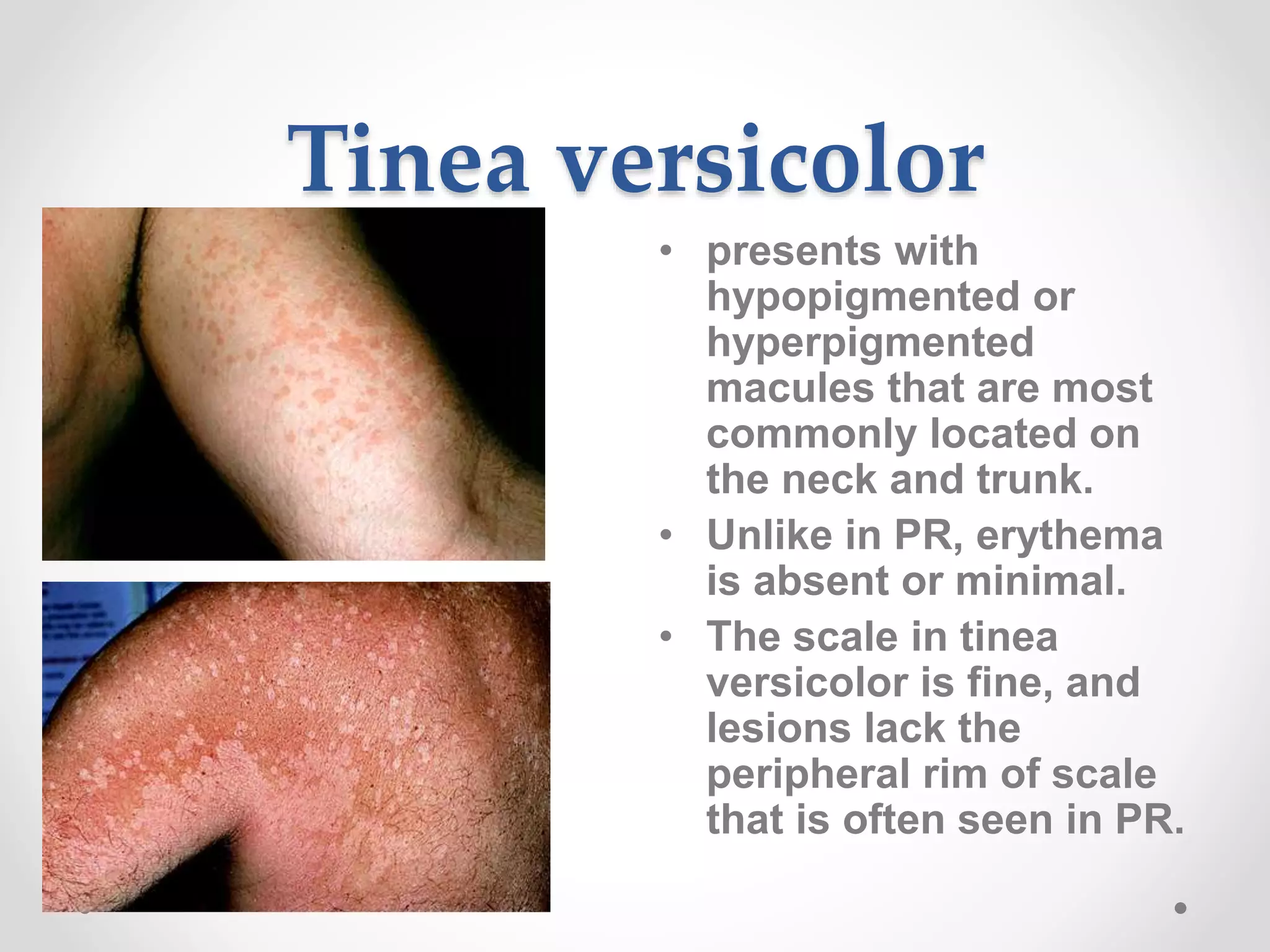 Pityriasis rosea | PPTX