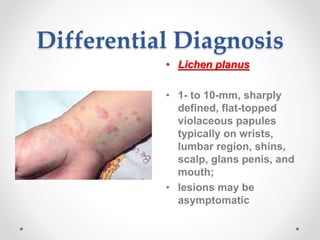 Pityriasis rosea | PPTX