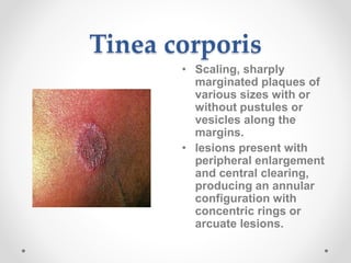 Pityriasis rosea | PPTX