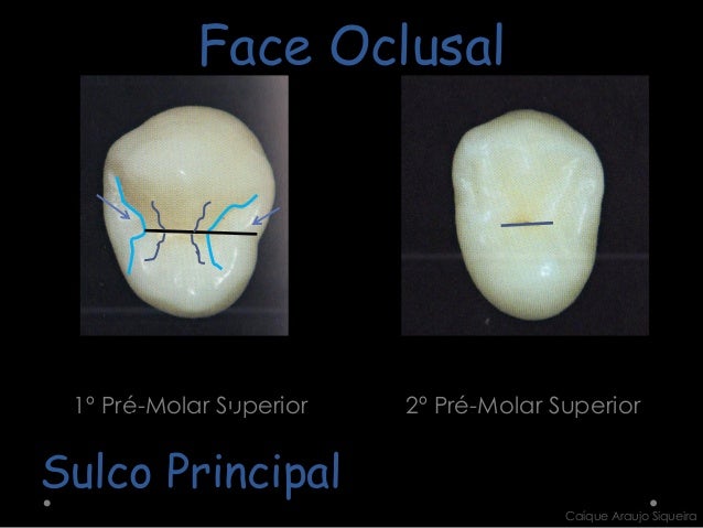 Pré Molares Superiores