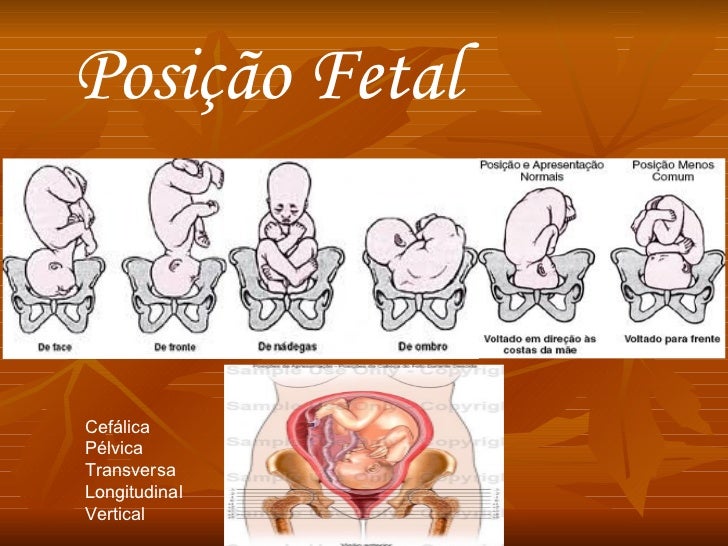 Feto Em Casos De Feto