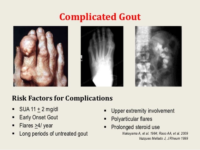 Gout, tophi and kidney disease