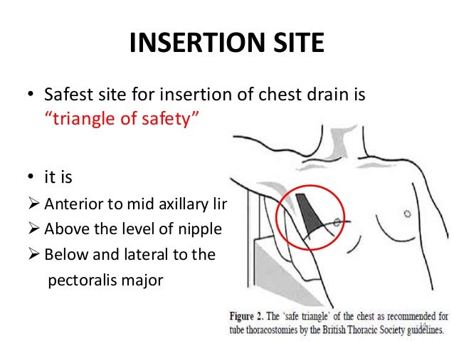 Safety Triangle For Chest Tube Tube Thoracostomy Dr Ellahi Bakhsh Routine Use Of Ultrasound