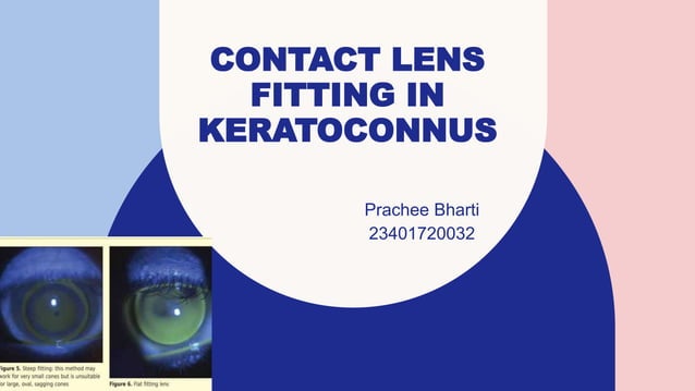 contact lens fitting in keratoconnus | PPTX | Eye and Vision Conditions ...