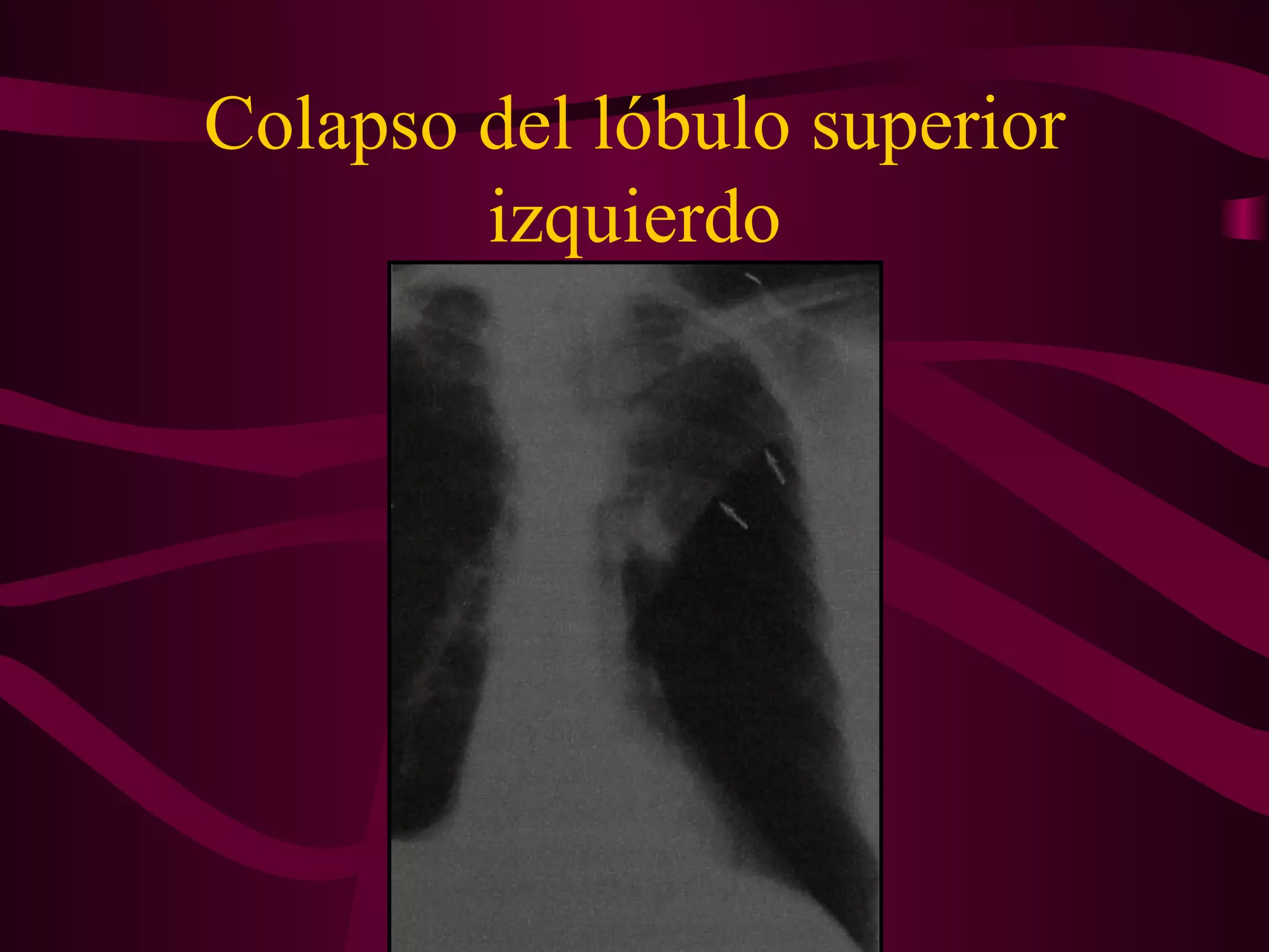 Colapso Lobar Y Segmentario | PPT