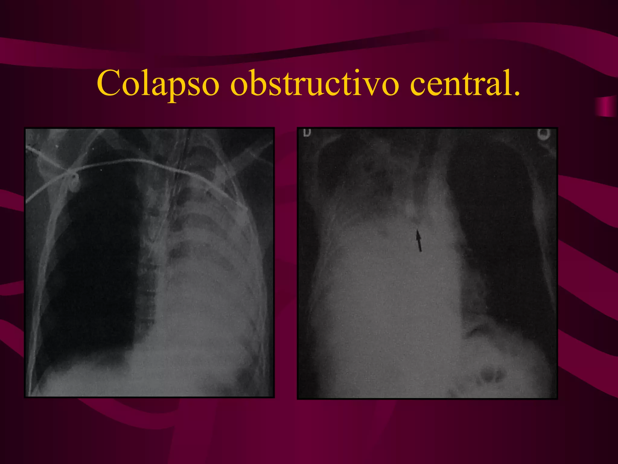 Colapso Lobar Y Segmentario | PPT