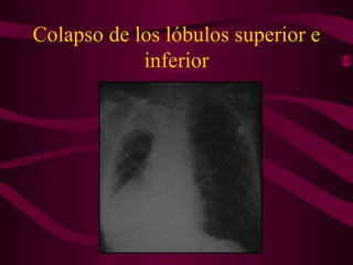 Colapso Lobar Y Segmentario | PPT