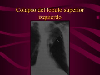 Colapso Lobar Y Segmentario | PPT