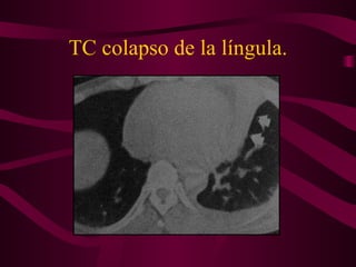 Colapso Lobar Y Segmentario | PPT
