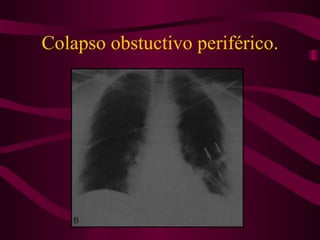 Colapso Lobar Y Segmentario | PPT