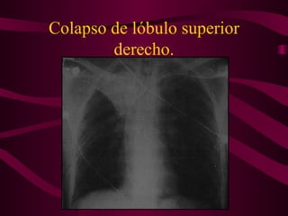 Colapso Lobar Y Segmentario | PPT