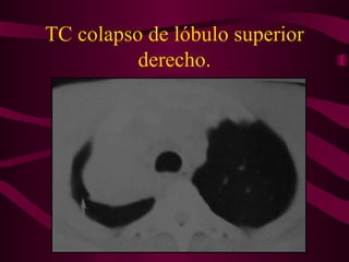 Colapso Lobar Y Segmentario | PPT