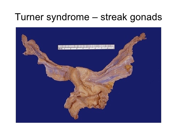 Streak Gonad – Streak Gonad とは – NXFJO