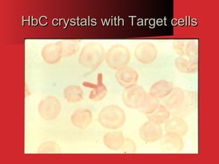Hemoglobin Electrophoresis (Biochemistry) | PPT