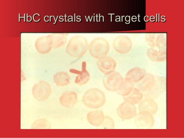 Hemoglobin Electrophoresis (Biochemistry)