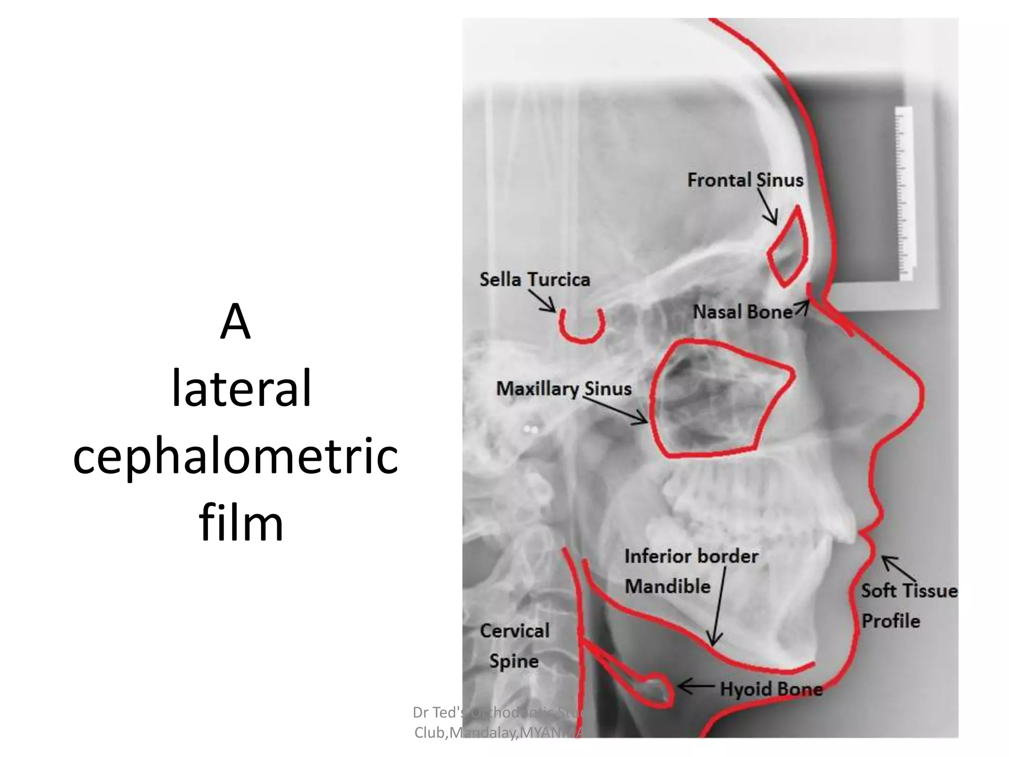 Practical cephalometric tracing | PPTX